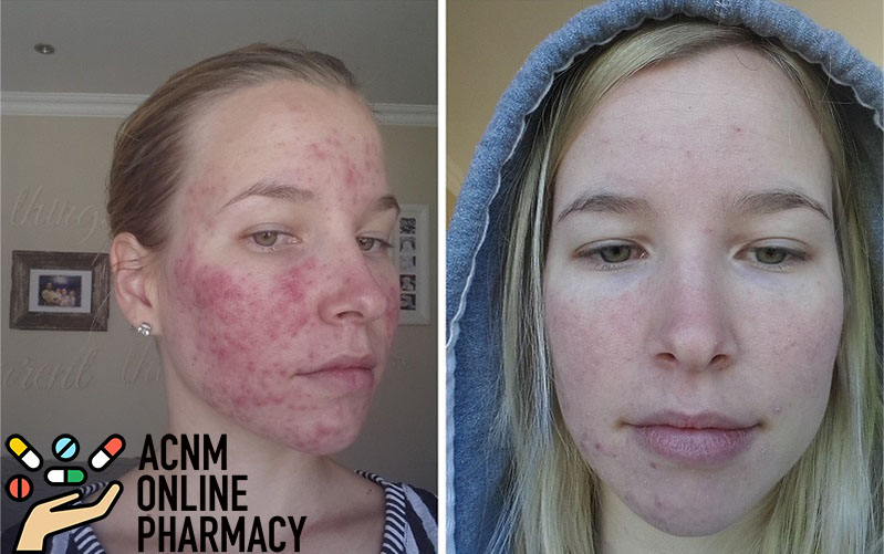 Accutane: Acne Treatment drug reviews, pics before and after, cost and ...